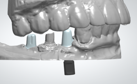Implant Prosthesis – Easy Dent Dental | Website