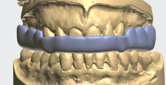 All Prosthesis – Easy Dent Dental | Website