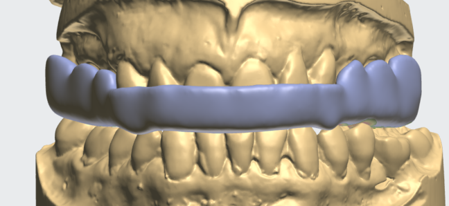 All Prosthesis – Easy Dent Dental | Website